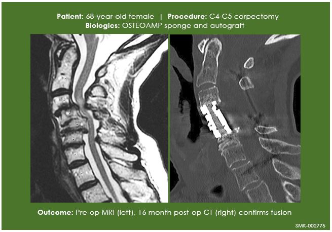 Supply Chain Guide to Spinal Biologics - Bioventus Surgical